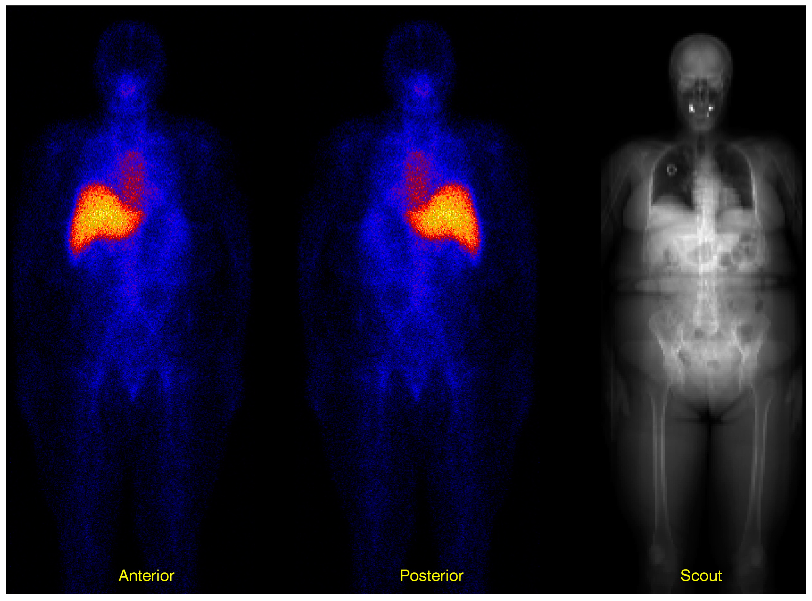 Biomedicines | Free Full-Text | Personalized Dosimetry for Radionuclide ... Biomedicines | Free Full-Text | Personalized Dosimetry for Radionuclide ...
