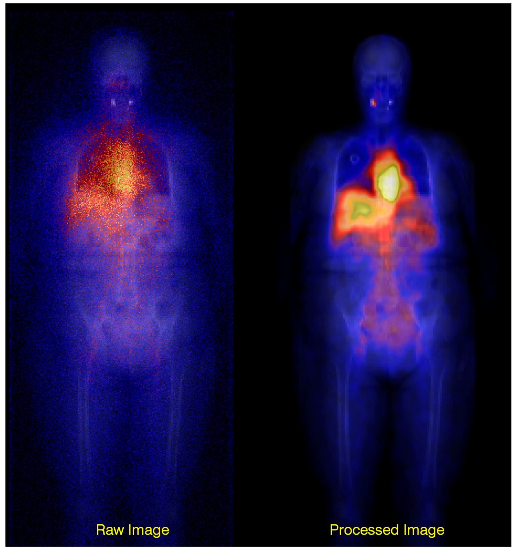 Biomedicines | Free Full-Text | Personalized Dosimetry for Radionuclide ... Biomedicines | Free Full-Text | Personalized Dosimetry for Radionuclide ...