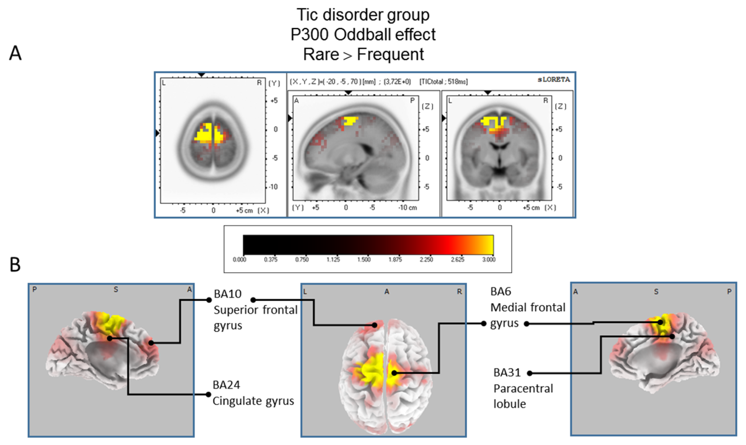 Brain Sciences | Free Full-Text | P300 Source Localization Contrasts in ... Brain Sciences | Free Full-Text | P300 Source Localization Contrasts in ...