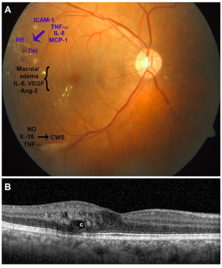IJMS | Special Issue : Diabetic Retinopathy: Mechanisms underlying ... IJMS | Special Issue : Diabetic Retinopathy: Mechanisms underlying ...