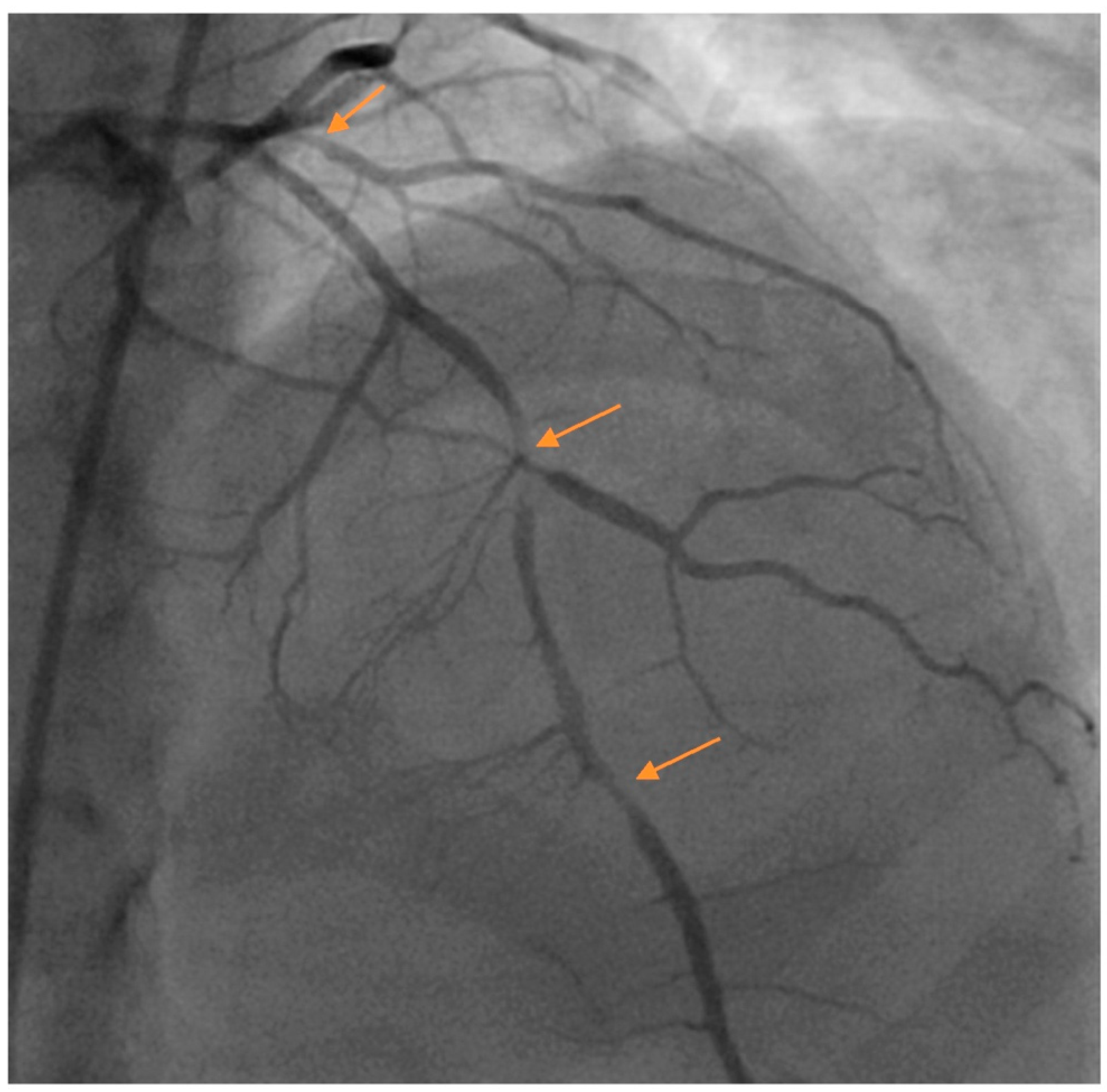 JCM | Free Full-Text | Update in Spontaneous Coronary Artery Dissection JCM | Free Full-Text | Update in Spontaneous Coronary Artery Dissection