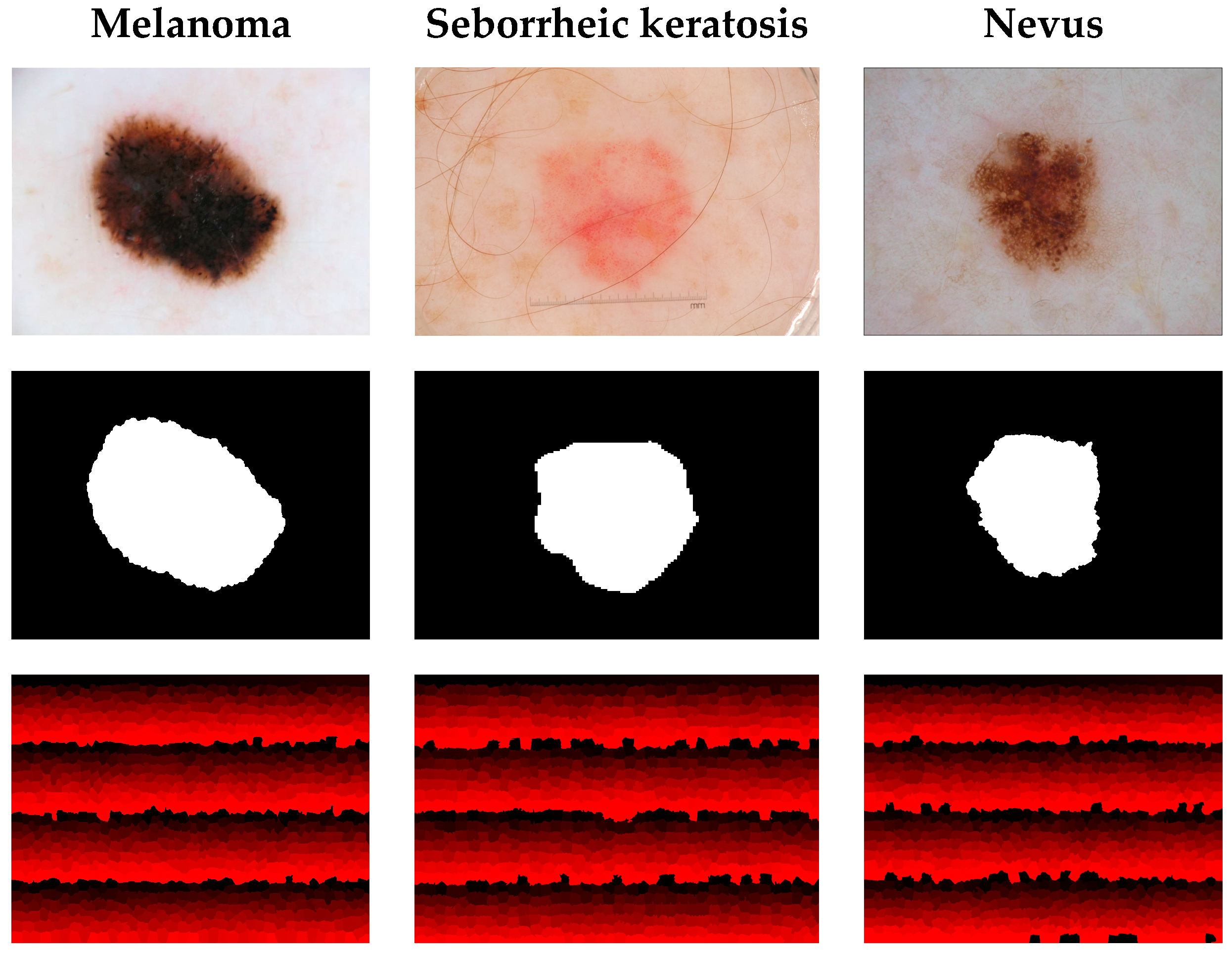 Sensors Free Full Text Skin Lesion Analysis Towards Melanoma