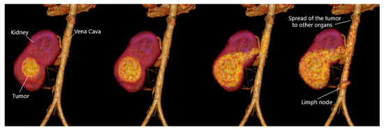 Radiology Imaging Scans for Early Diagnosis of Kidney Tumors: A Review ...