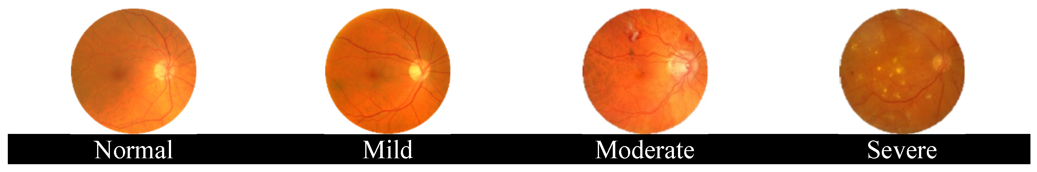 Image Fundus Classification System for Diabetic Retinopathy Stage ...