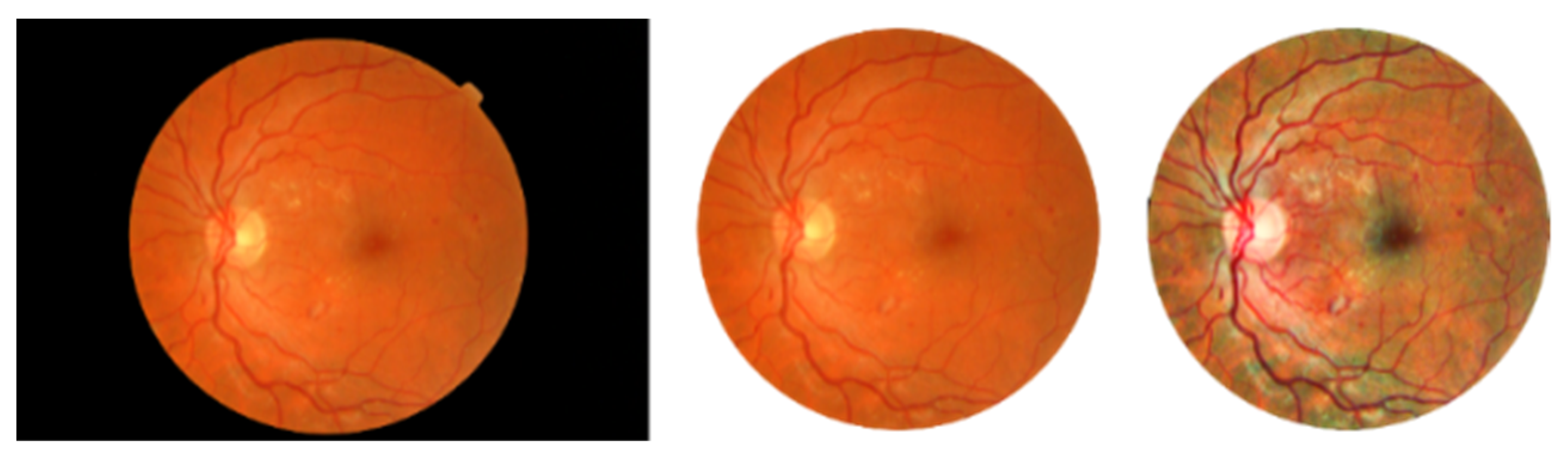 Image Fundus Classification System for Diabetic Retinopathy Stage ...