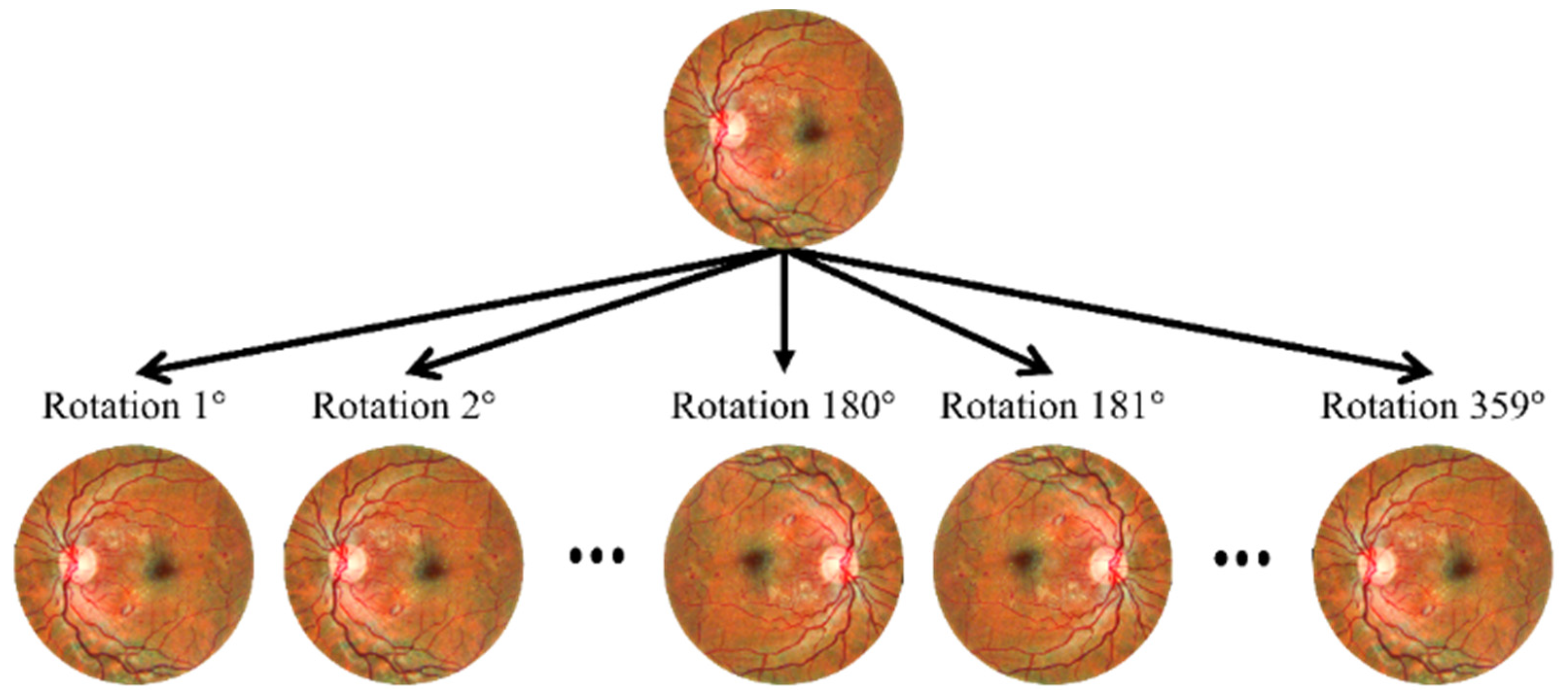 Image Fundus Classification System for Diabetic Retinopathy Stage Detection Using Hybrid CNN-DELM