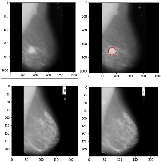 Breast Cancer Detection and Localizing the Mass Area Using Deep Learning