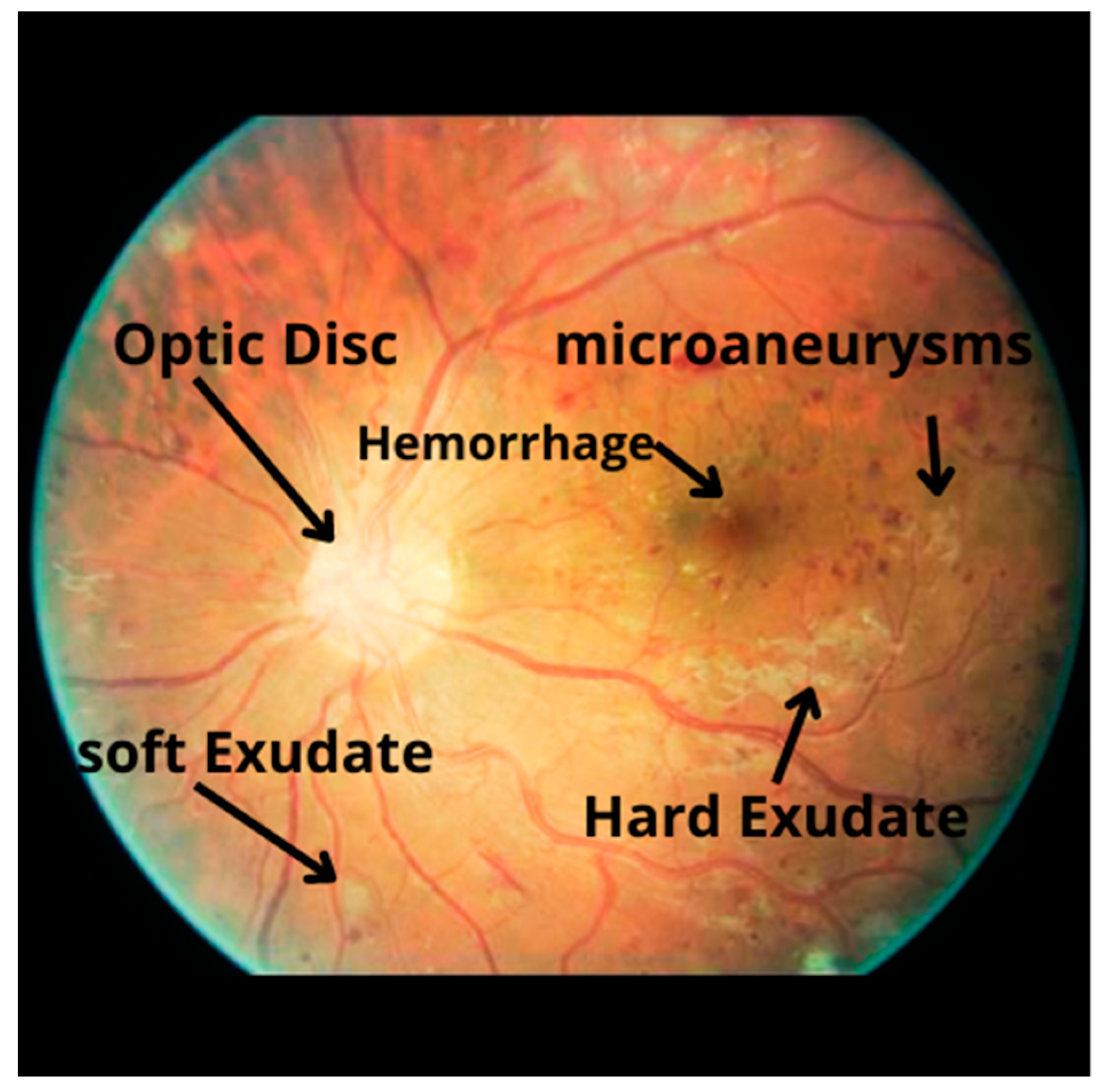 DRCCT: Enhancing Diabetic Retinopathy Classification with a Compact Convolutional Transformer