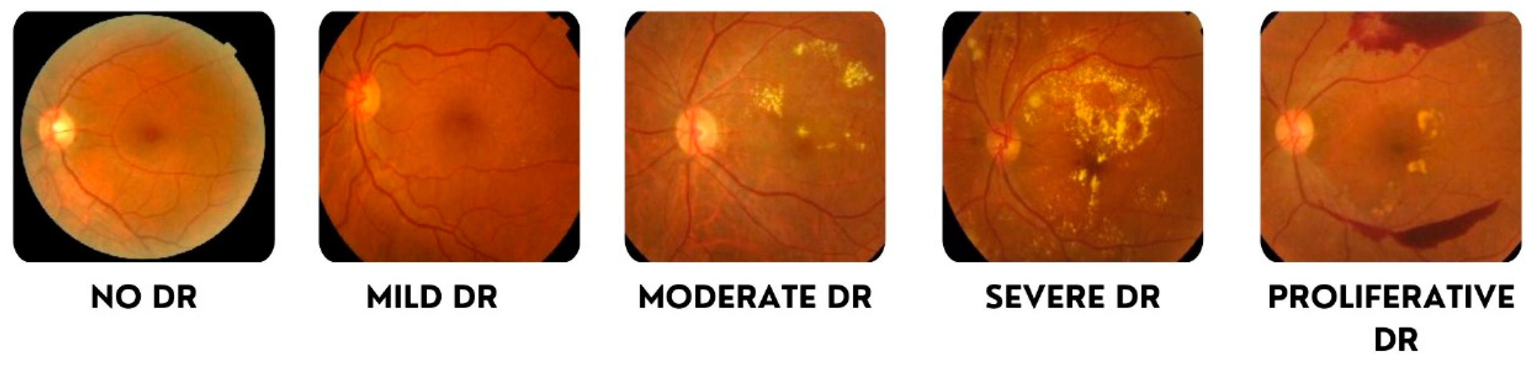 DRCCT: Enhancing Diabetic Retinopathy Classification with a Compact Convolutional Transformer