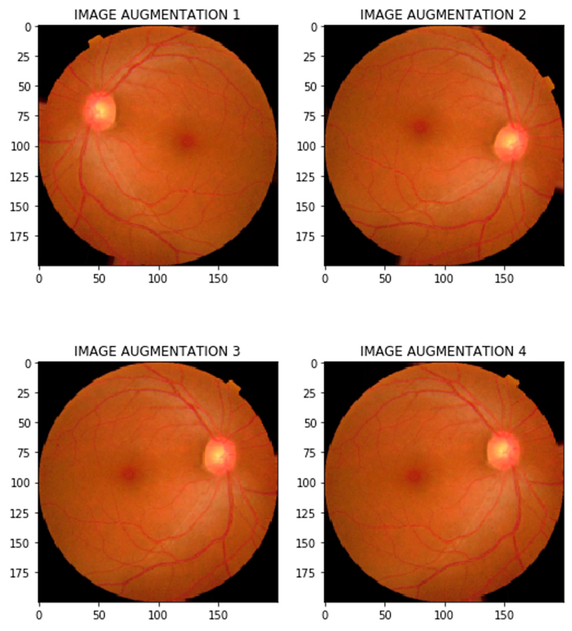DRCCT: Enhancing Diabetic Retinopathy Classification with a Compact Convolutional Transformer