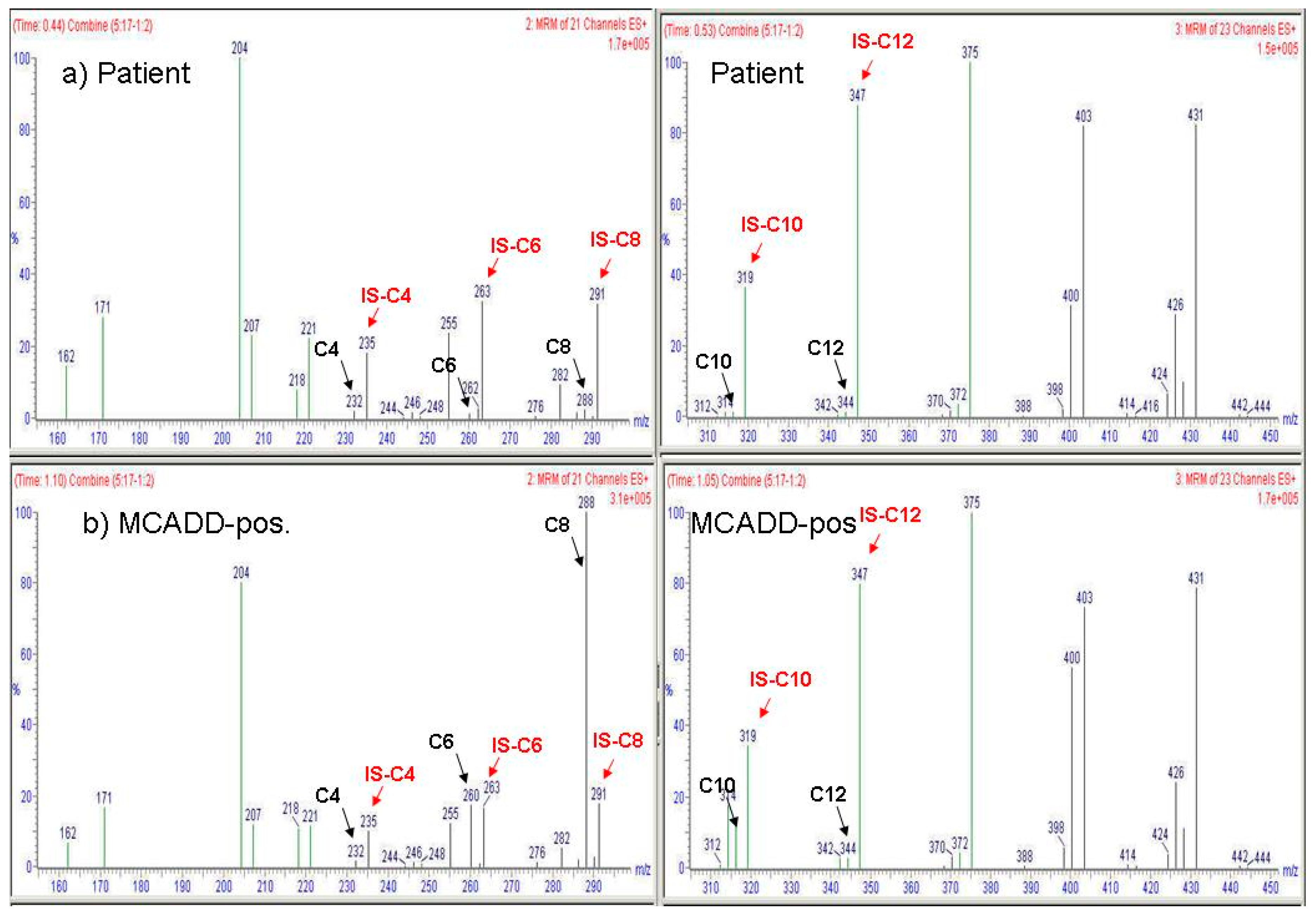 MCAD-Deficiency with Severe Neonatal Onset, Fatal Outcome and Normal ...