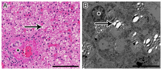 MCAD-Deficiency with Severe Neonatal Onset, Fatal Outcome and Normal ...