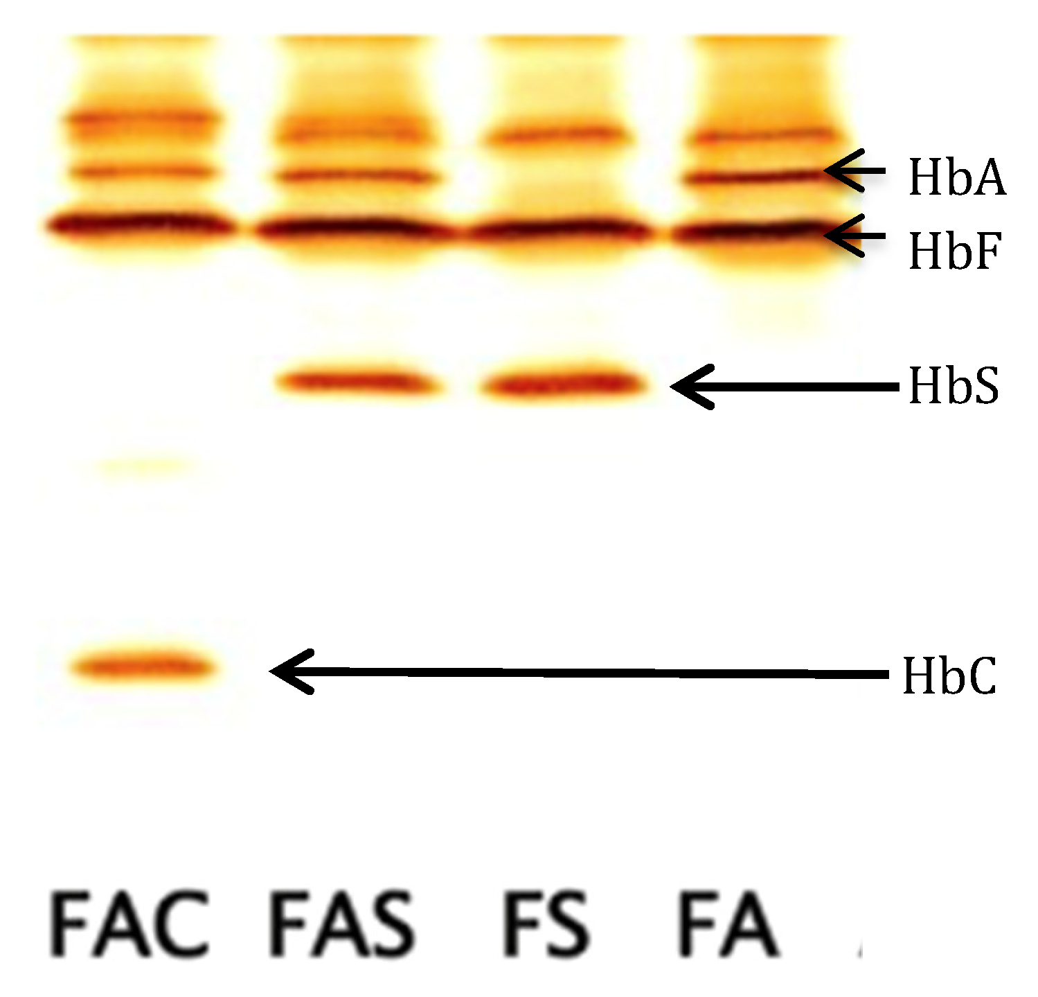 Newborn Screening for Sickle Cell Disease and Other Hemoglobinopathies ...