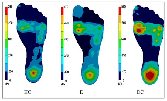 Diabot: Development of a Diabetic Foot Pressure Tracking Device