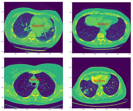 Deep Learning for Lung Cancer Nodules Detection and Classification in CT Scans