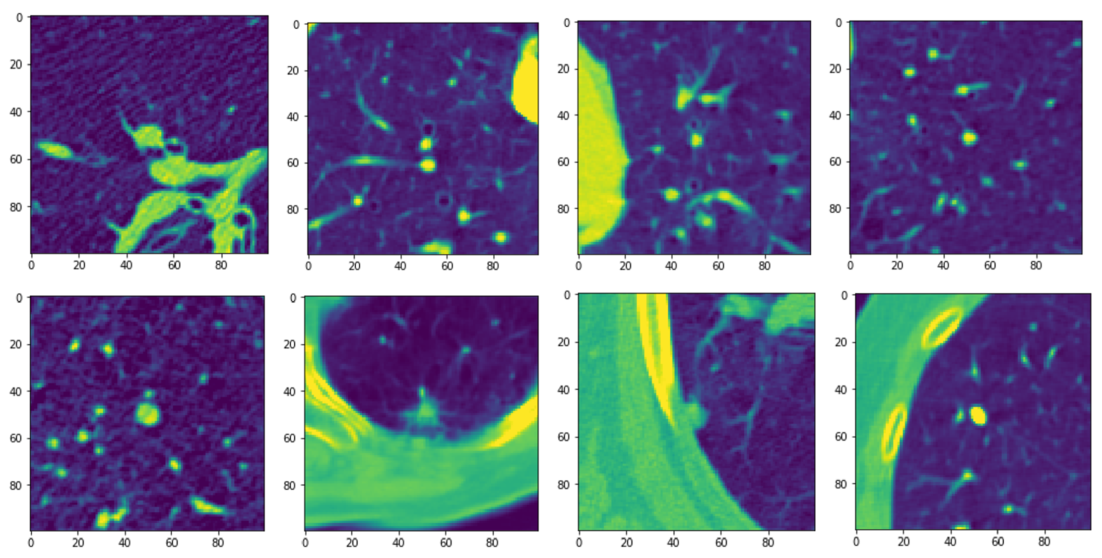 Deep Learning for Lung Cancer Nodules Detection and Classification in ...