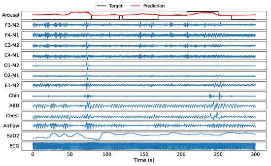 DeepSleep 2.0: Automated Sleep Arousal Segmentation via Deep Learning
