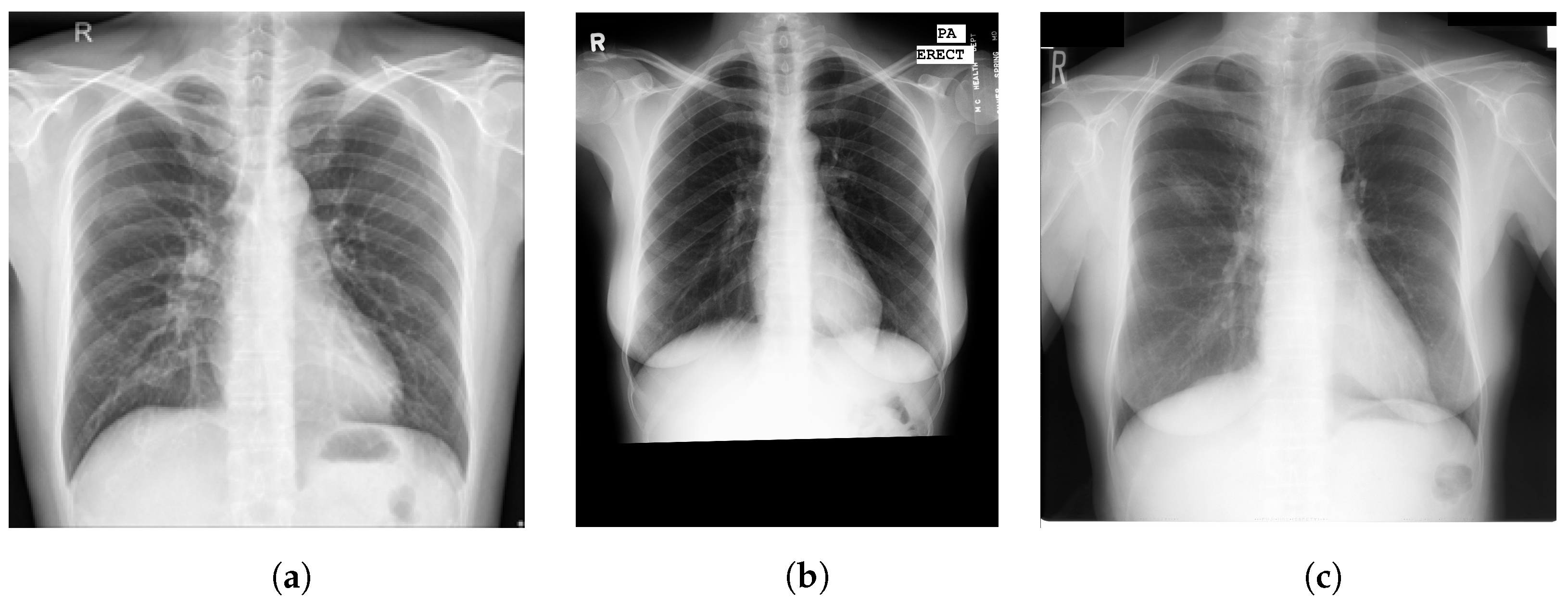Ai Free Full Text A Patient Specific Algorithm For Lung Segmentation In Chest Radiographs