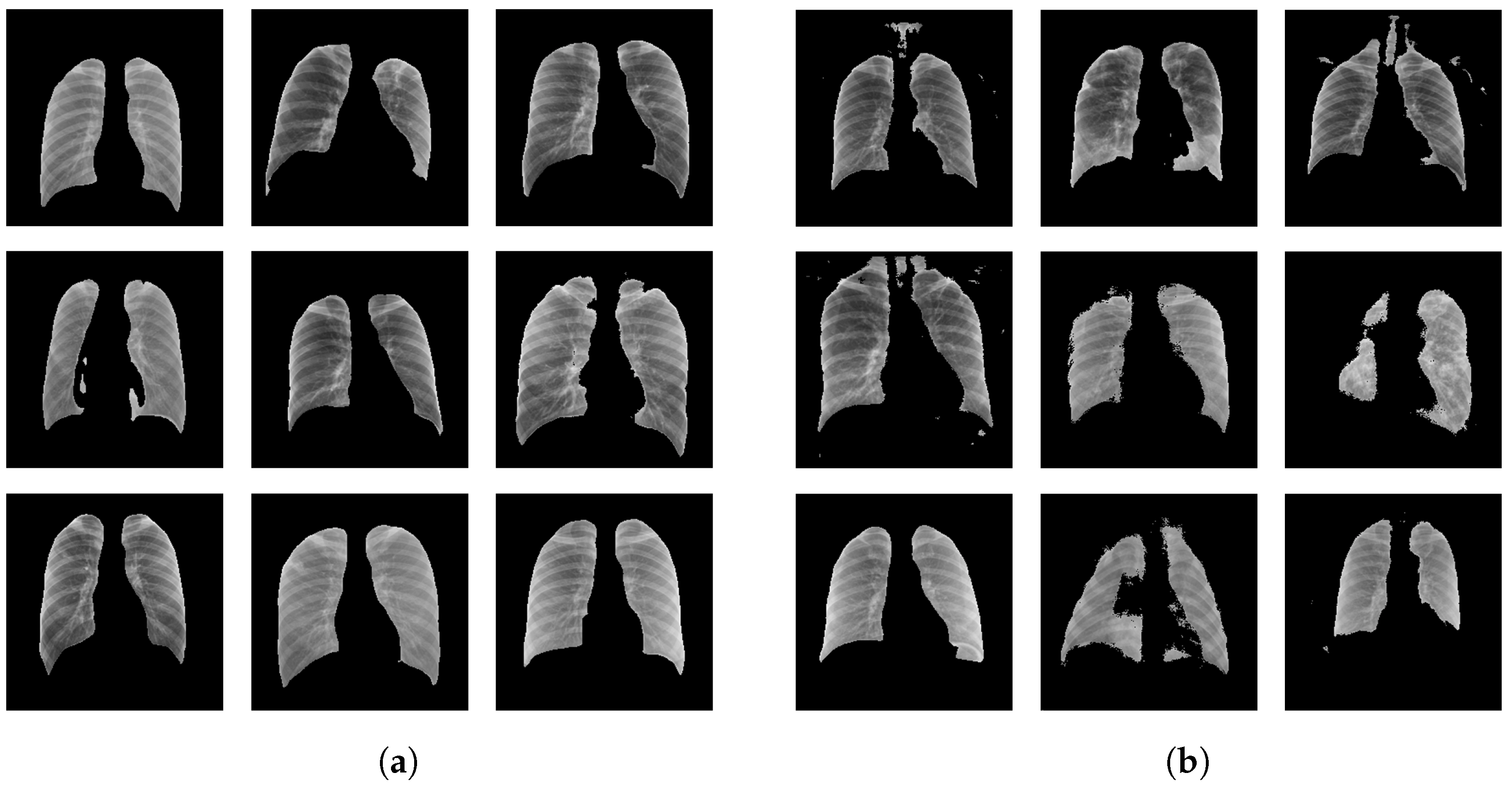 Ai Free Full Text A Patient Specific Algorithm For Lung Segmentation In Chest Radiographs