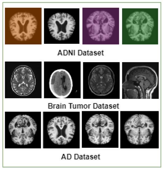AI | Free Full-Text | Improving Alzheimer’s Disease and Brain Tumor Detection Using Deep ...
