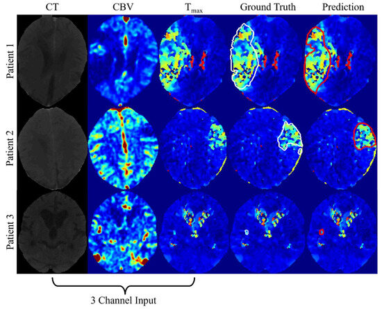 Ischemic Stroke Lesion Segmentation on Multiparametric CT Perfusion Maps Using Deep Neural Network