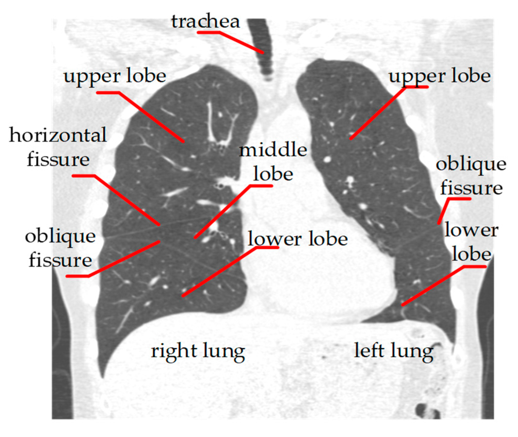 Chest X Ray Anatomy Lung Lobes And Fissures In The Ri
