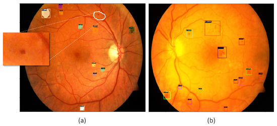 Detectron2 for Lesion Detection in Diabetic Retinopathy