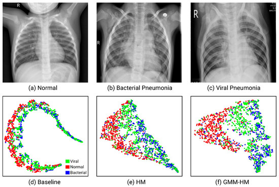 An Improved Heteroscedastic Modeling Method for Chest X-ray Image ...