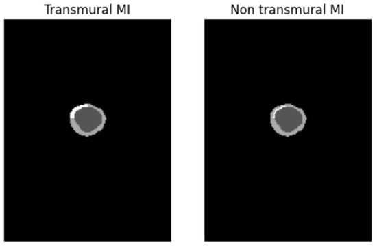 Automatic Myocardium Segmentation in Delayed-Enhancement MRI with Pathology-Specific Data ...