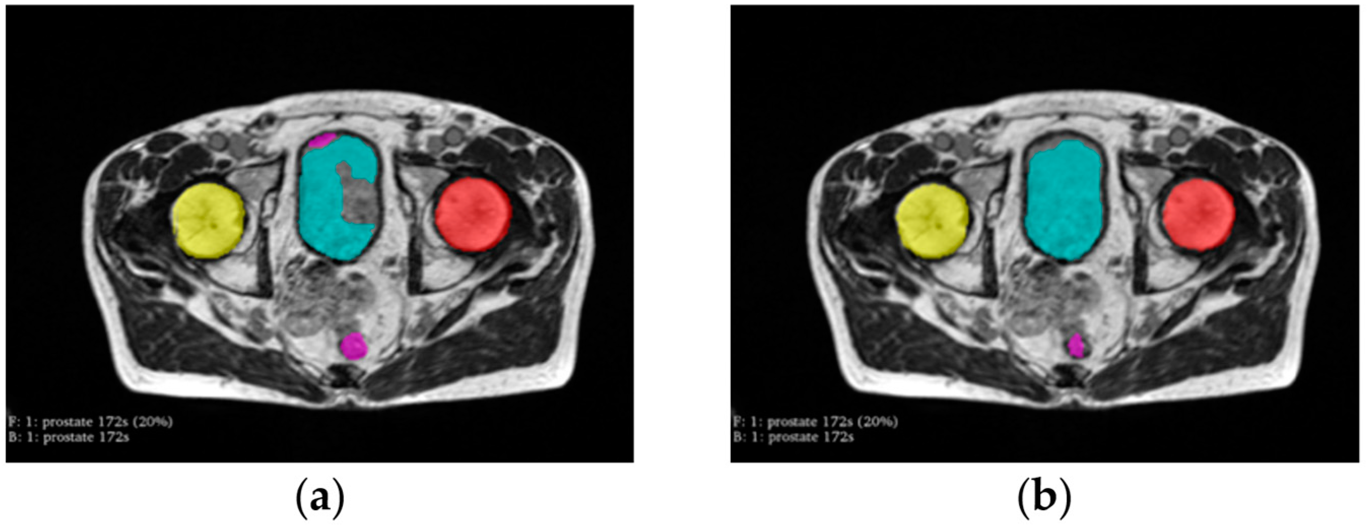 Automatic Multiorgan Segmentation In Pelvic Region With Convolutional Neural Networks On 035 T
