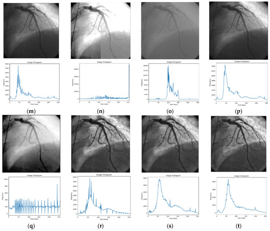 Fast Local Laplacian Filter Based on Modified Laplacian through Bilateral Filter for Coronary ...
