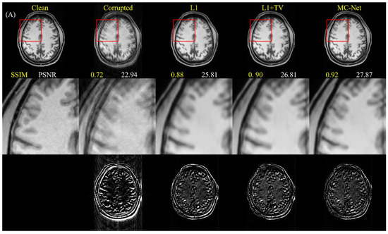 Motion Correction for Brain MRI Using Deep Learning and a Novel Hybrid ...