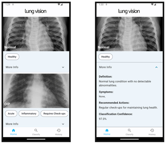 LungVision: X-ray Imagery Classification for On-Edge Diagnosis Applications