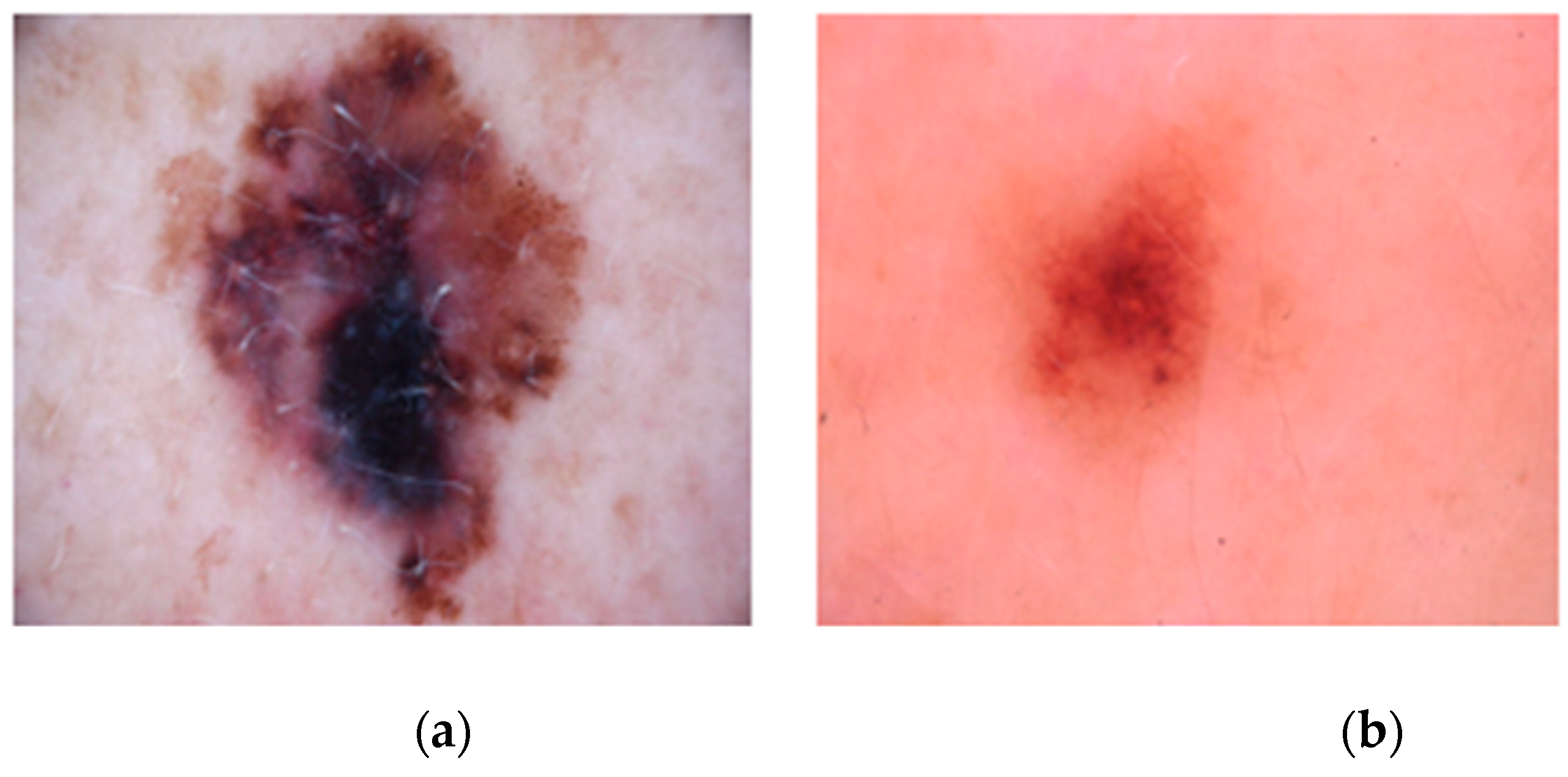 An Efficient AdaBoost Algorithm for Enhancing Skin Cancer Detection and ...