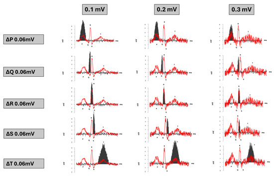 Detection of Subtle ECG Changes Despite Superimposed Artifacts by ...
