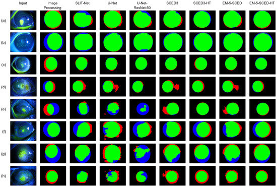 A Segmentation-Based Automated Corneal Ulcer Grading System for Ocular Staining Images Using ...
