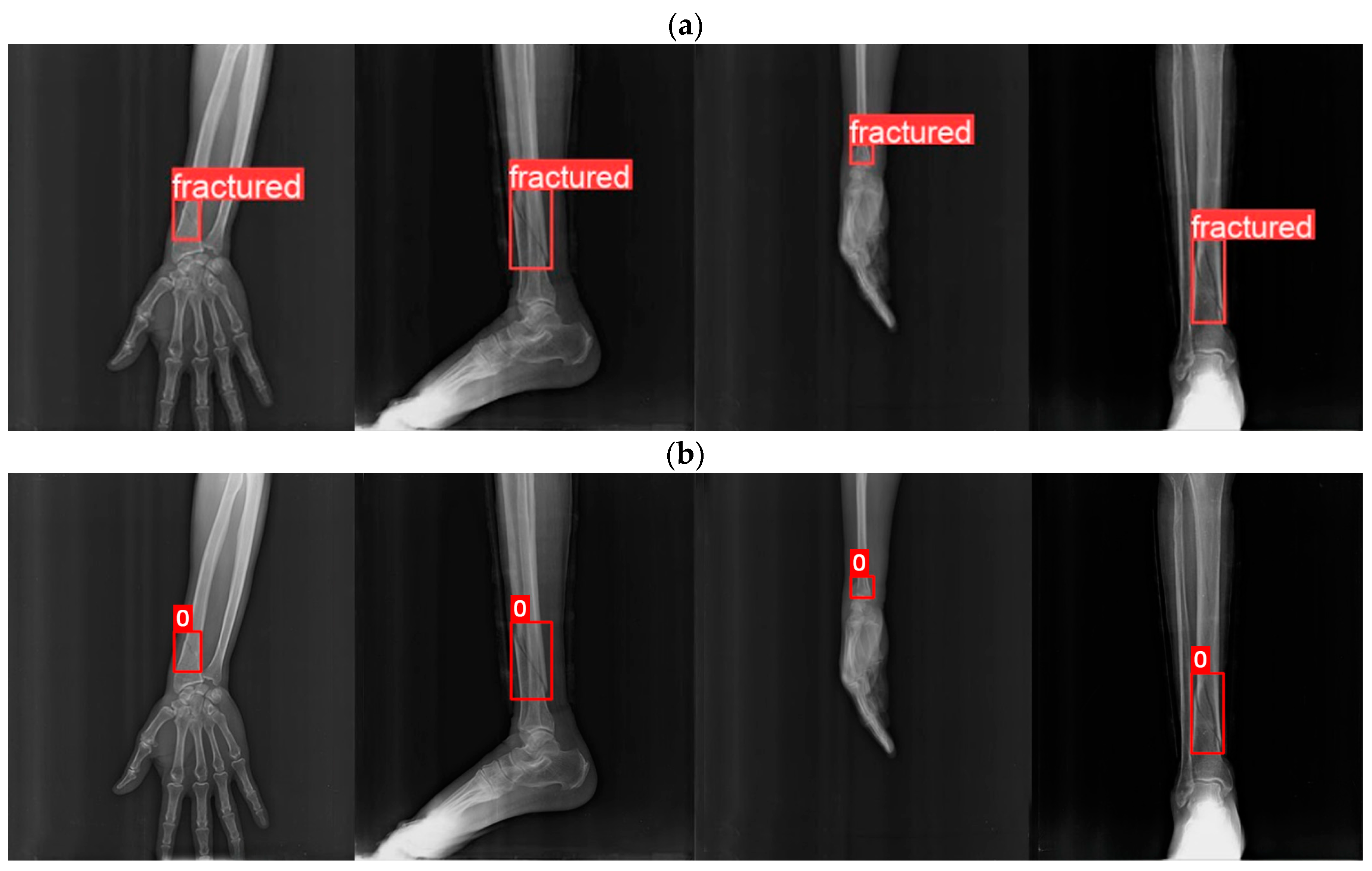 Deep Learning Approach For Arm Fracture Detection Based On An Improved Yolov8 Algorithm