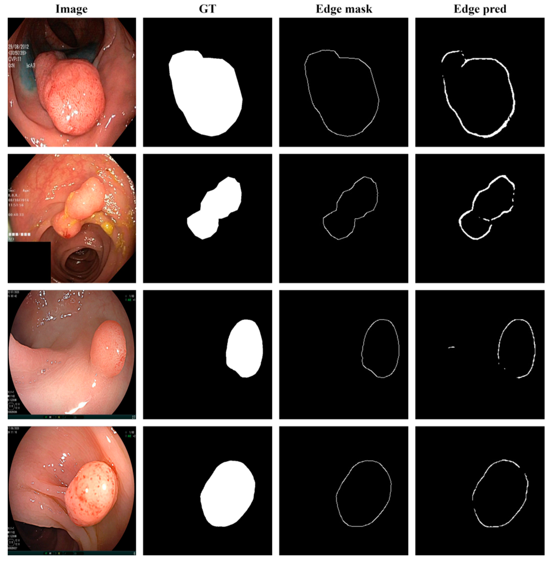 Mseanet Multi Scale Selective Edge Aware Network For Polyp Segmentation