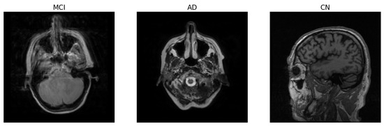 Explainable MRI-Based Ensemble Learnable Architecture for Alzheimer’s Disease Detection