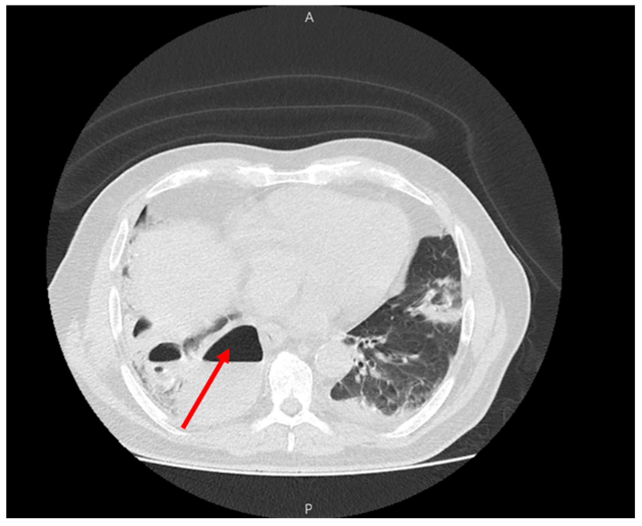 Pulmonary Cavitation as a Complication of COVID-19: Case Series and a ...
