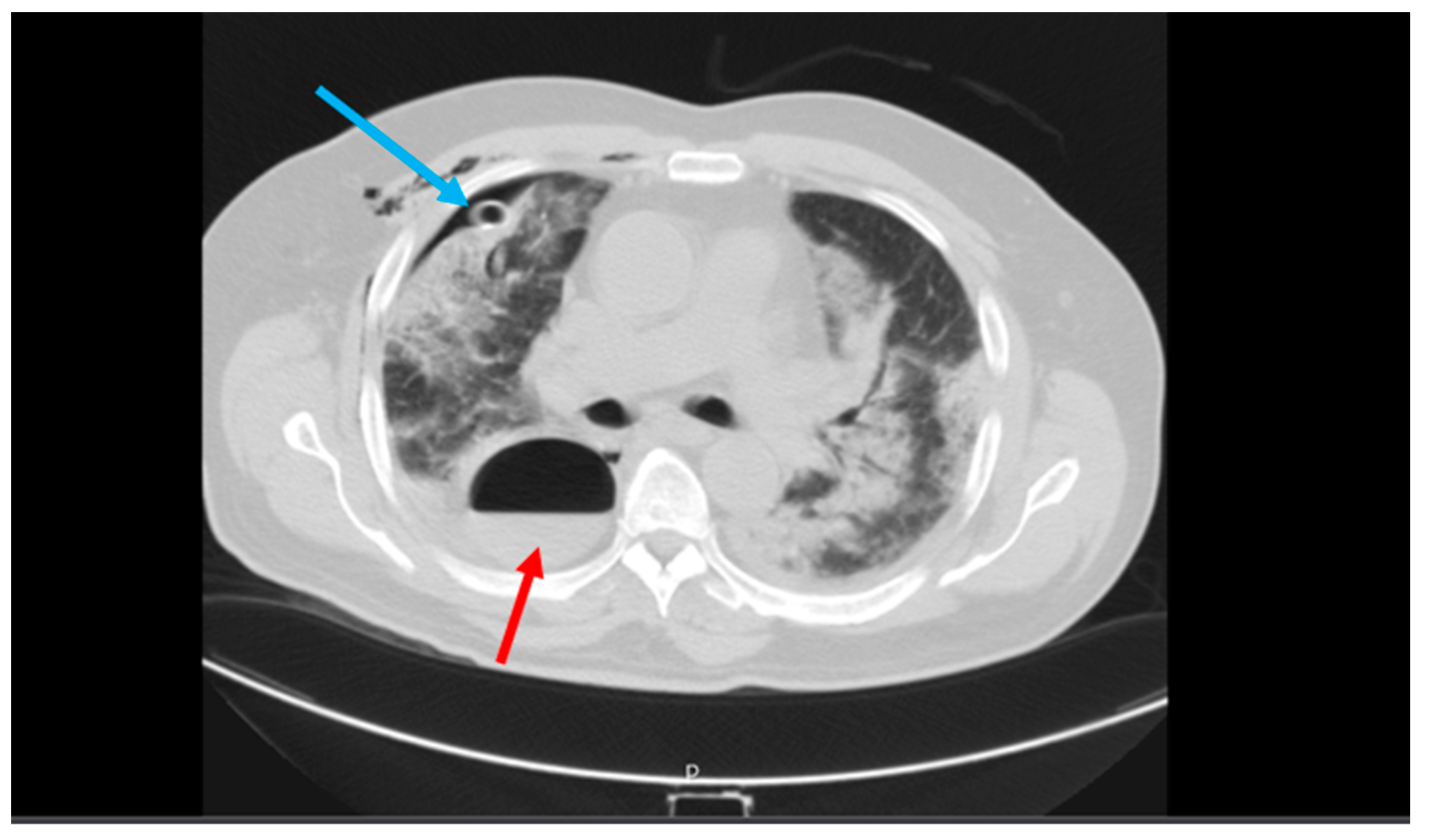 Pulmonary Cavitation as a Complication of COVID-19: Case Series and a ...