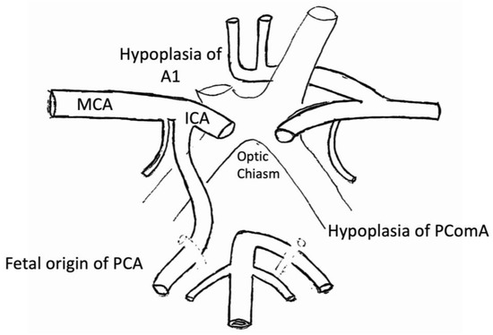 Anatomia | Free Full-Text | Anatomy of Cerebral Arteries with Clinical ...