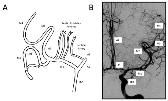 Anatomy of Cerebral Arteries with Clinical Aspects in Patients with ...