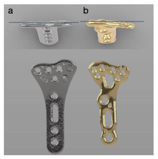 Do Anatomical Differences of the Volar Rim of the Distal Radius Affect ...