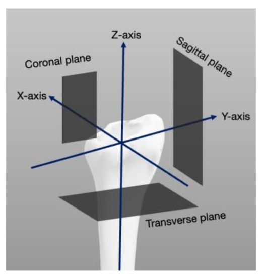 Do Anatomical Differences of the Volar Rim of the Distal Radius Affect ...
