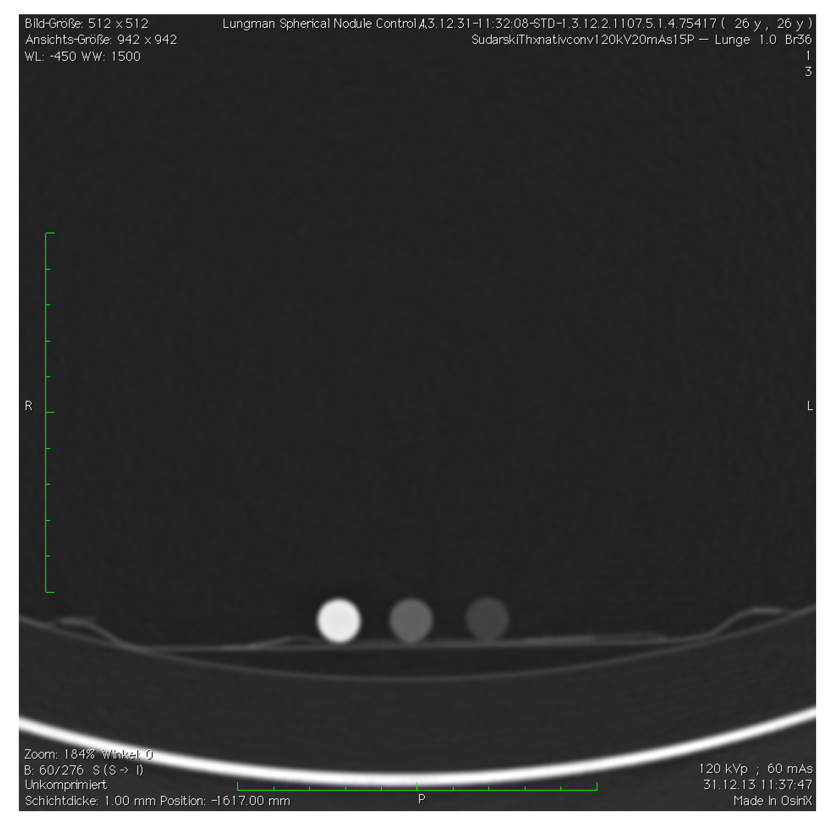 Observer Sensitivity for Detection of Pulmonary Nodules in Ultra-Low ...