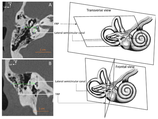 Anatomical Variations of Modiolus in Relation with Vestibular and ...