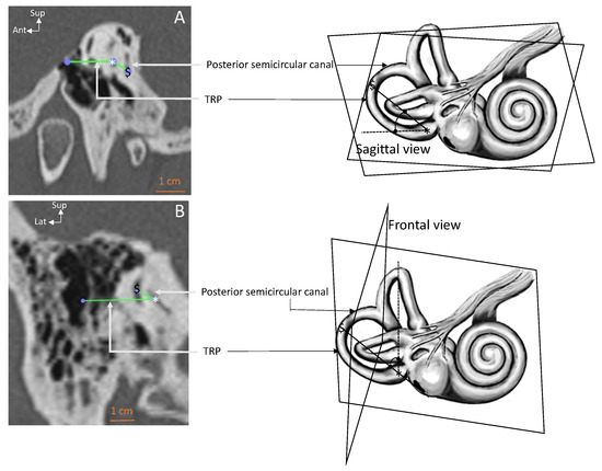 Anatomical Variations of Modiolus in Relation with Vestibular and ...