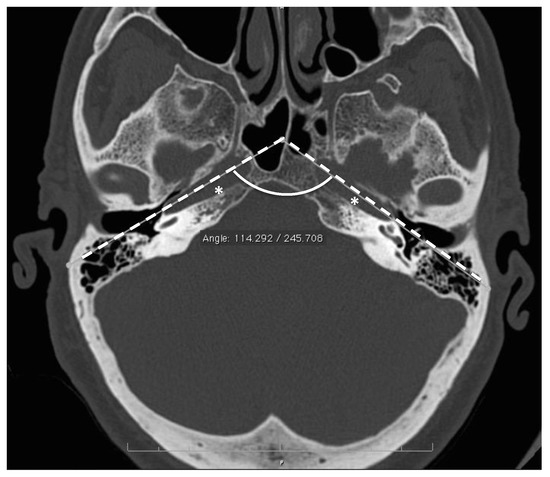 Anatomical Variations of Modiolus in Relation with Vestibular and ...