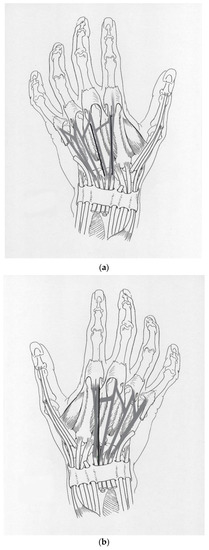 Presumed Presence of Extensor Indicis et Digiti Medii Communis Muscle ...